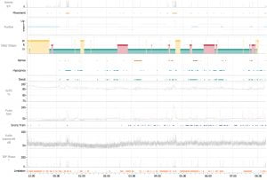 NOX T3s HST System - Nox Medical Sleep Lab Device