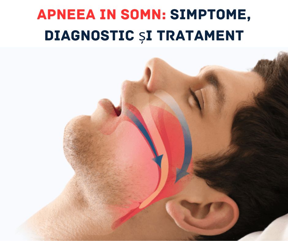 Ce este apneea în somn? Simptome, diagnostic și tratament